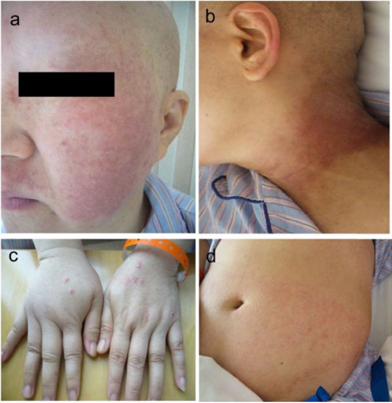 Higher rate of skin rash in a phase II trial with weekly nanoparticle ...