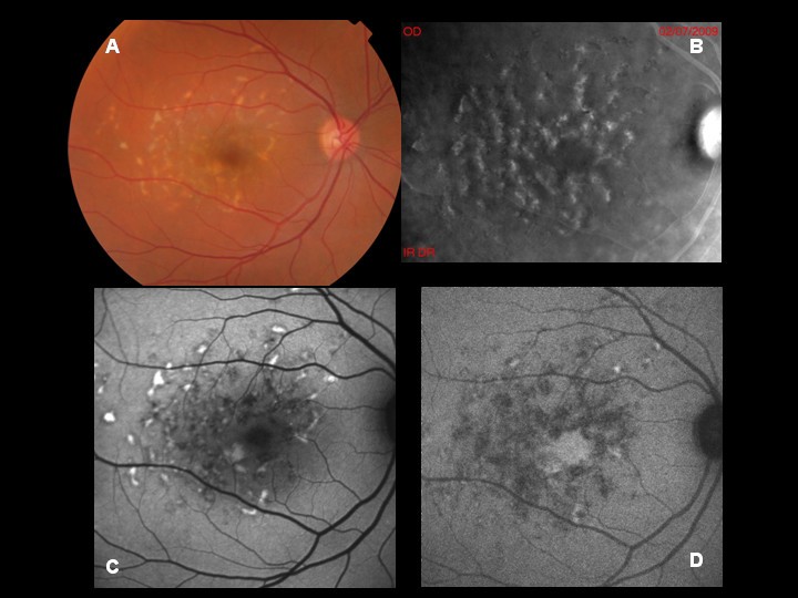 Retro-mode imaging and fundus autofluorescence with scanning laser ...