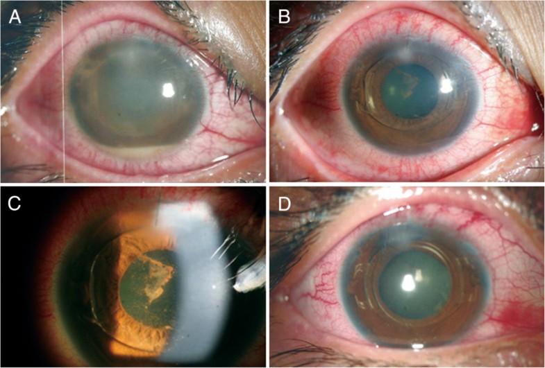 Streptococcus mitis/oralis endophthalmitis management without phakic ...