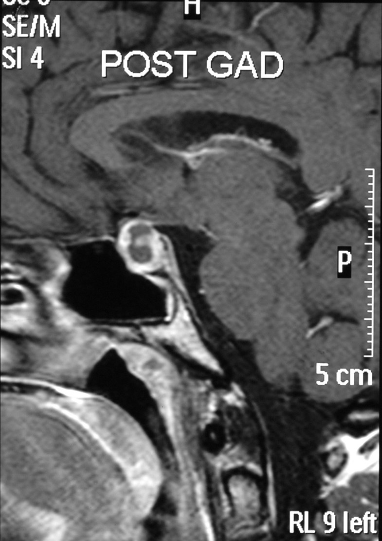Painful vertical diplopia as a presentation of a pituitary mass | BMC ...