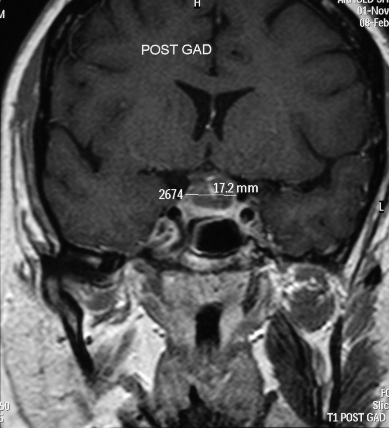 Painful vertical diplopia as a presentation of a pituitary mass | BMC ...