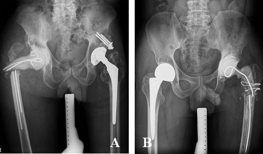 The effect of endoskeleton on antibiotic impregnated cement spacer for ...