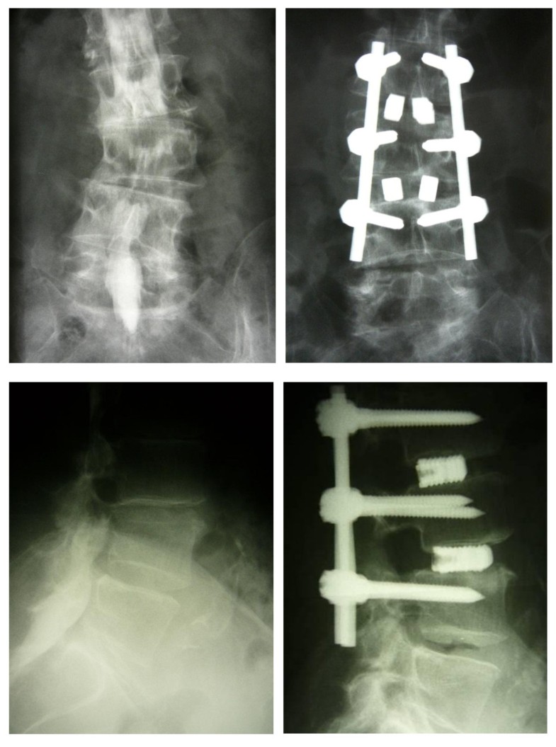 Instrumented intervertebral or posterolateral fusion in elderly ...