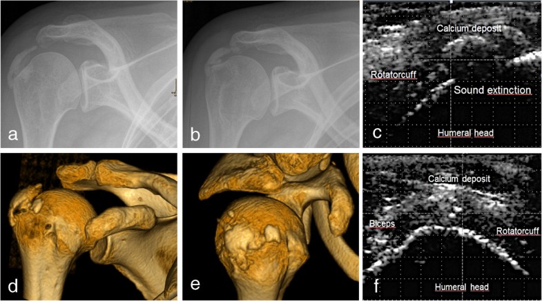 Preoperative planning of calcium deposit removal in calcifying ...