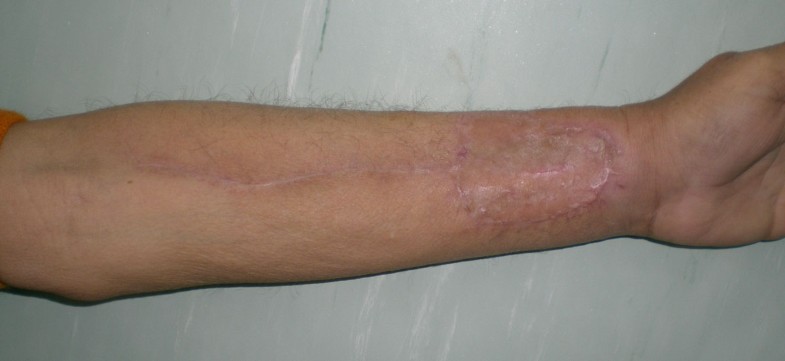 Microvascular free-flap transfer for head and neck reconstruction in ...