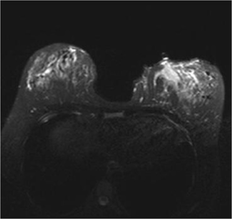 Management of idiopathic granulomatous mastitis: dilemmas in diagnosis ...