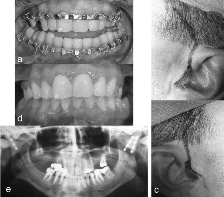 Open reduction and internal fixation of extracapsular mandibular ...