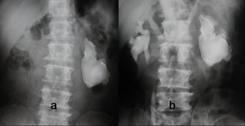 Laparoscopic nephrectomy for giant staghorn calculus with non ...