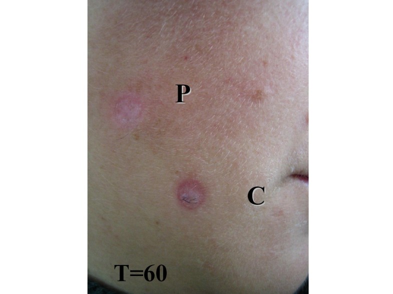 Assessment of the effect of phenytoin on cutaneous healing from ...
