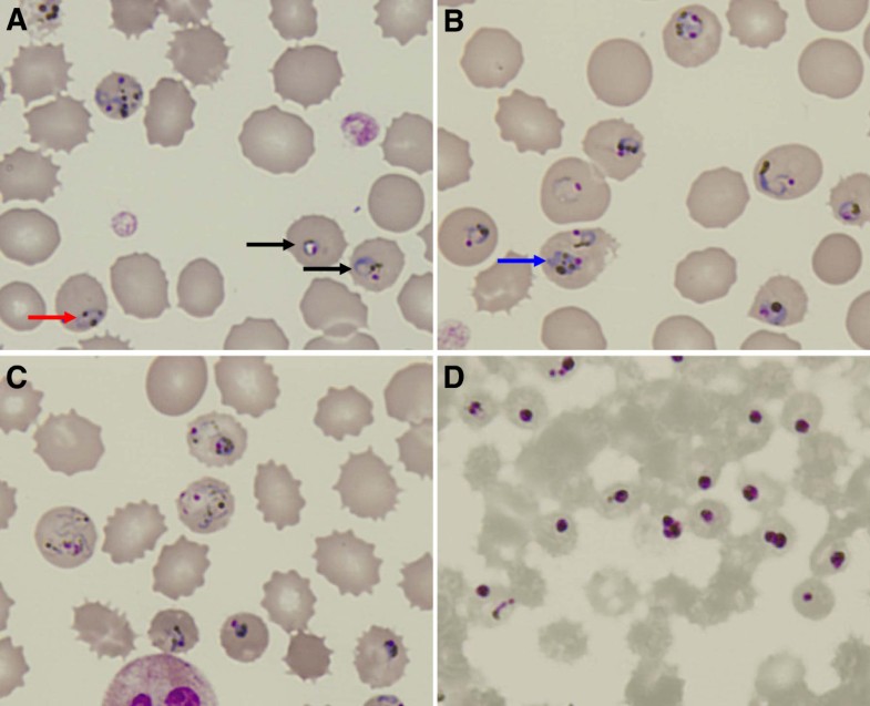 Hyperparasitaemic human Plasmodium knowlesi infection with atypical ...