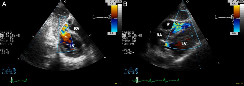 Septal rupture with right ventricular wall dissection after myocardial ...