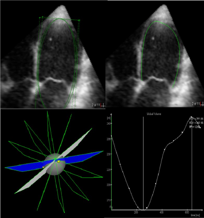 Flow-volume loops derived from three-dimensional echocardiography: a ...