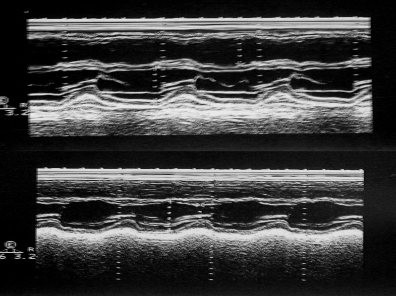 Hyperthyroidism as a reversible cause of right ventricular overload and ...