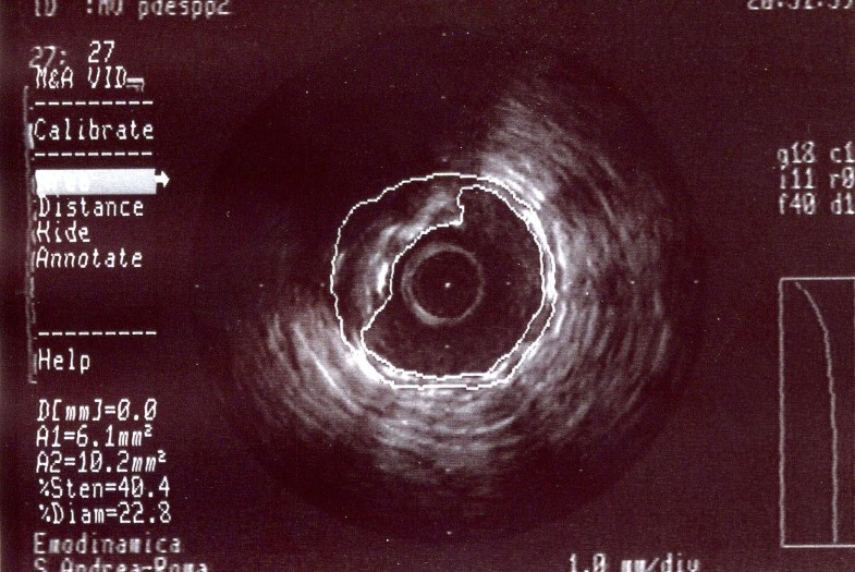 Effort angina in a patient with advanced coronary artery disease. Role ...