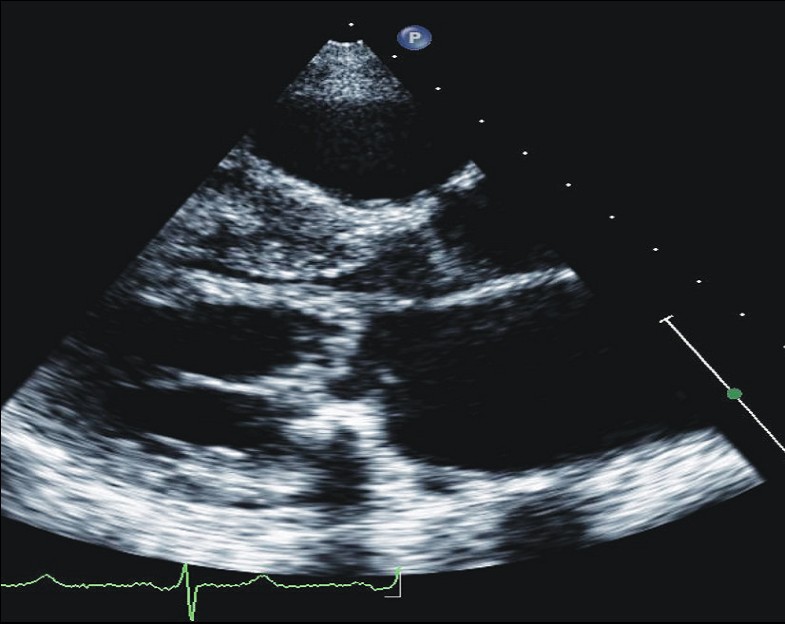 Echocardiography in patients with hypertrophic cardiomyopathy ...