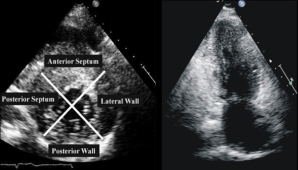 Echocardiography in patients with hypertrophic cardiomyopathy ...