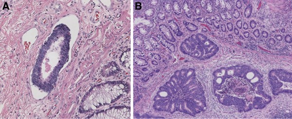 Endoscopically observable white nodule caused by distal intramural ...