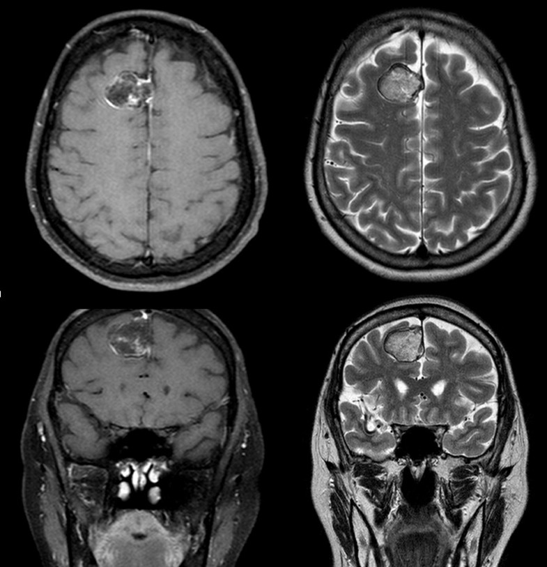 Solitary intracranial osteoma with attachment to the falx: a case ...