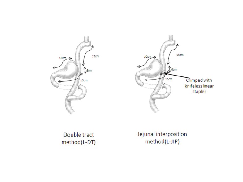 Functional outcomes by reconstruction technique following laparoscopic ...