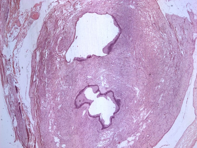 Mucinous cystic neoplasms of the mesentery: a case report and review of ...