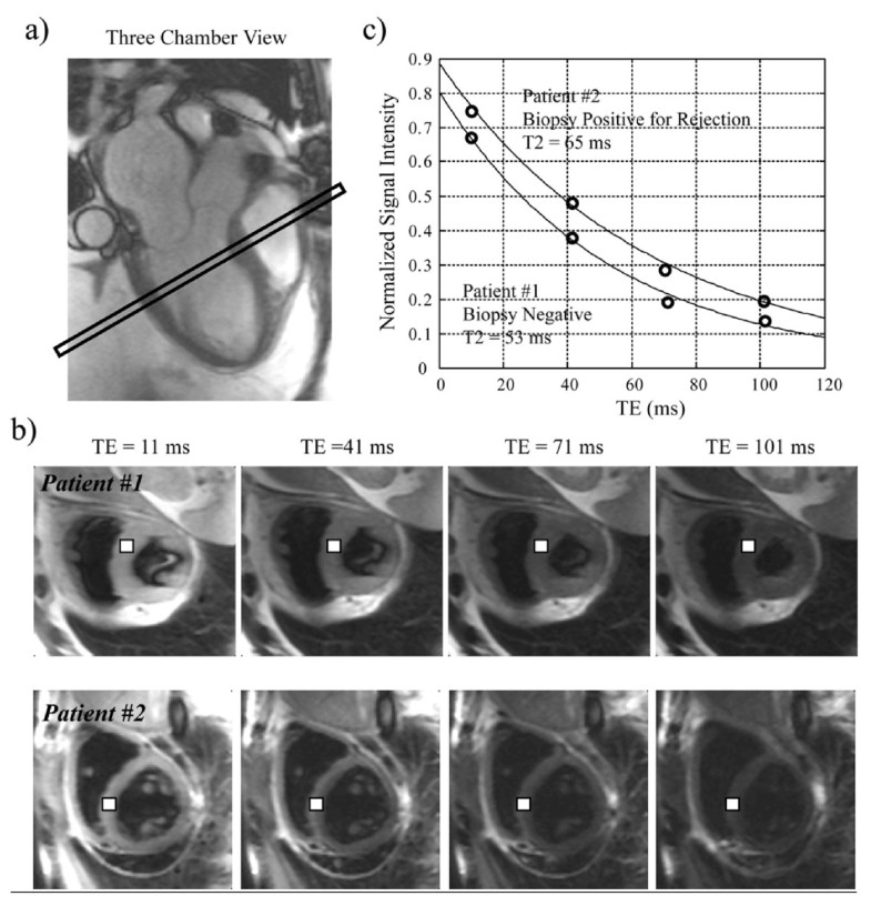 Cardiovascular magnetic resonance in the diagnosis of acute heart ...