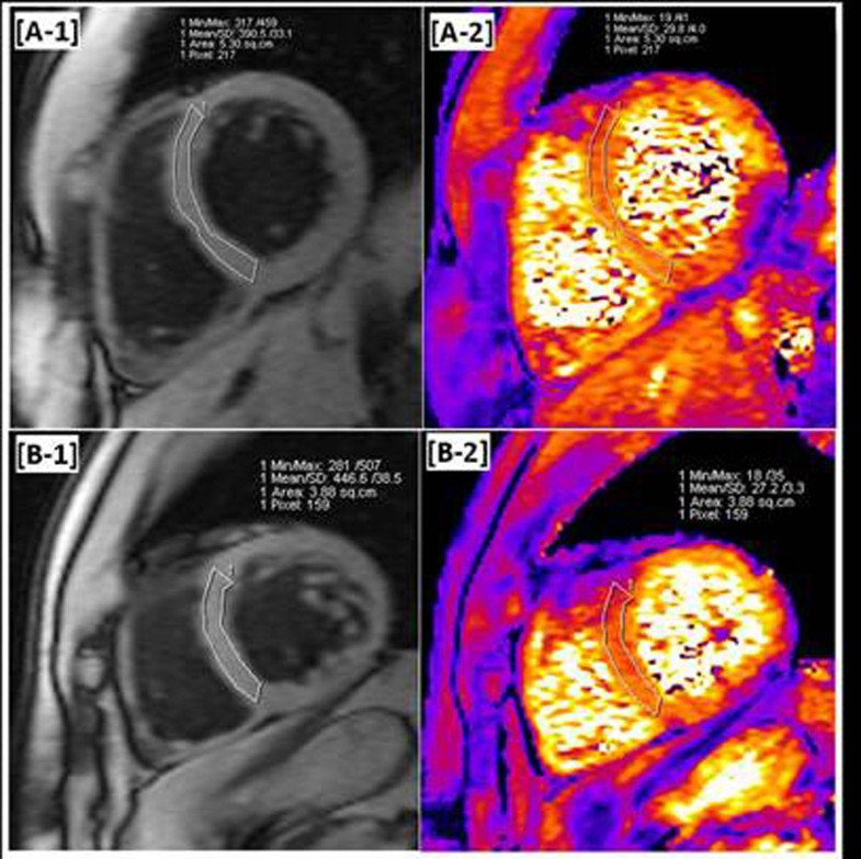 Inline myocardial t2* mapping with iterative robust fitting | Journal of Cardiovascular Magnetic ...