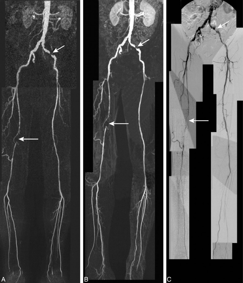 3t Versus 1 5t Mr Angiography In Peripheral Arterial Occlusive Disease