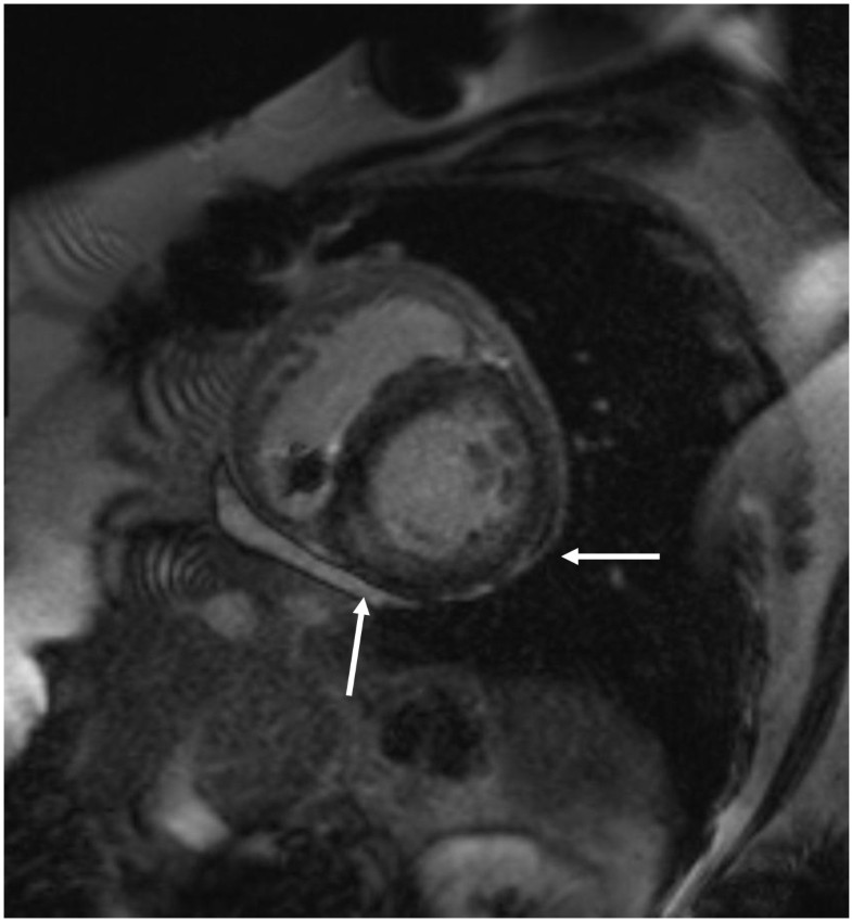 Cardiovascular magnetic resonance with an MR compatible pacemaker ...