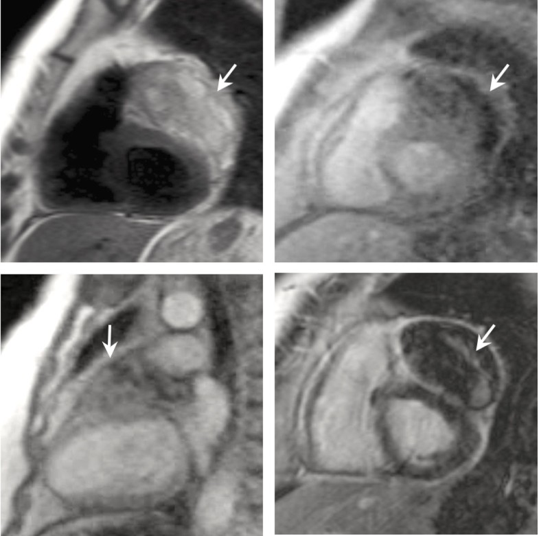 Magnetic resonance imaging of cardiac tumors: experience of a tertiary ...