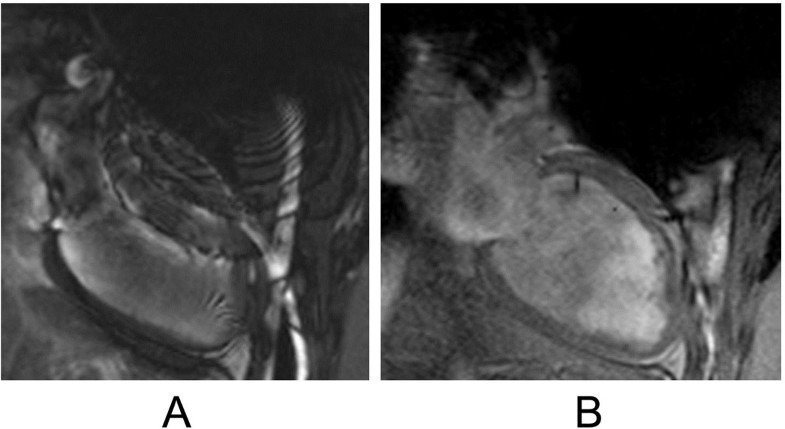 Experience with cardiac MR imaging of patients with legacy ICDs or ...