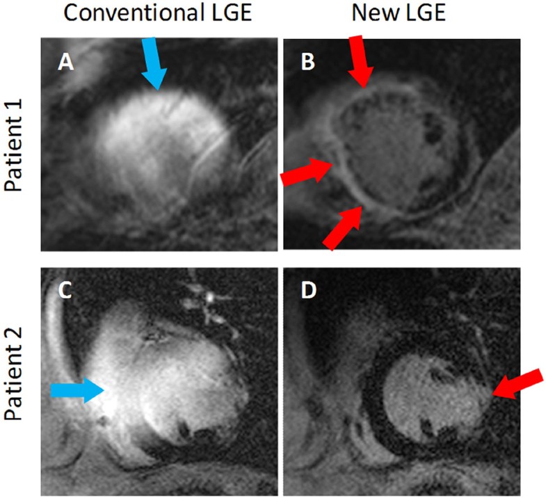 Artifact reduction with a wideband late gadolinium enhancement (LGE ...