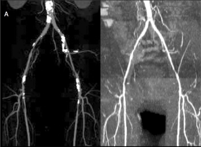 Neutral contrast MRI for the detection of peripheral arterial wall ...