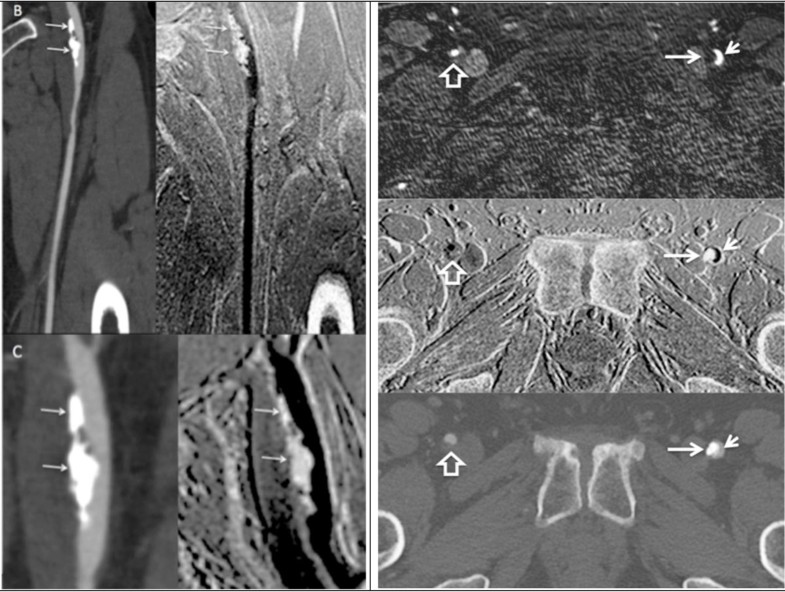 Neutral contrast MRI for the detection of peripheral arterial wall ...