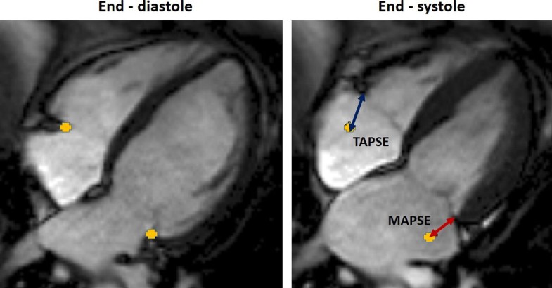 A simple technique to measure TAPSE and MAPSE on CMR and normal values ...