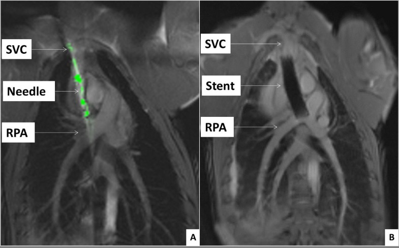 Transcatheter bidirectional Glenn shunt guided by real-time MRI ...