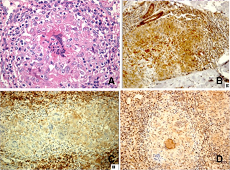 Blau Syndrome, the prototypic auto-inflammatory granulomatous disease ...