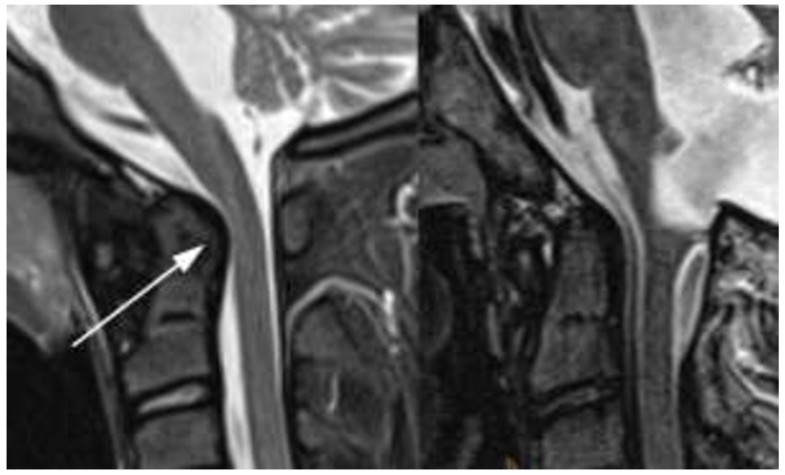 Cervical spine involvement in patients with juvenile idiopathic ...
