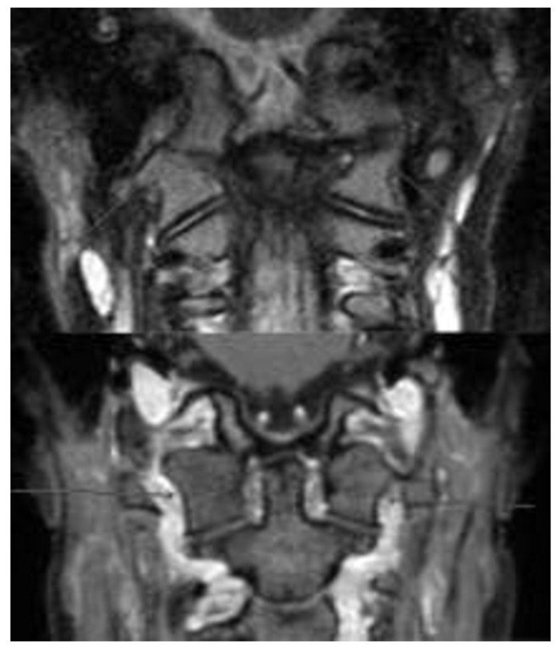 Cervical spine involvement in patients with juvenile idiopathic ...