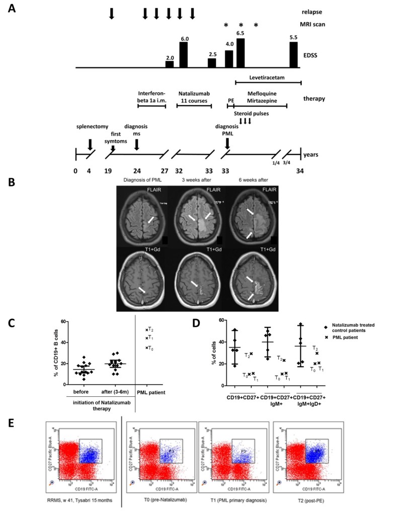 Immunological and clinical consequences of splenectomy in a multiple ...