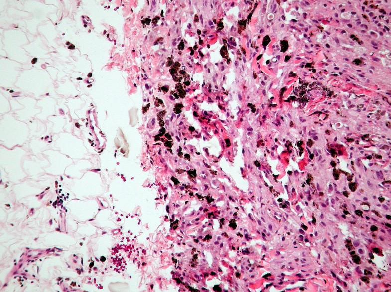 Deep penetrating nevus: a case report and brief literature review ...