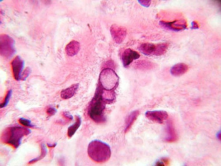 Deep penetrating nevus: a case report and brief literature review ...