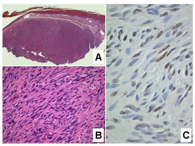 Histological variants of cutaneous Kaposi sarcoma | Diagnostic Pathology | Full Text