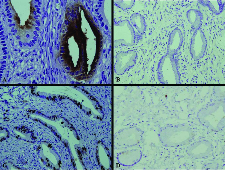 Clonal Status And Clinicopathological Observation Of Cervical Minimal