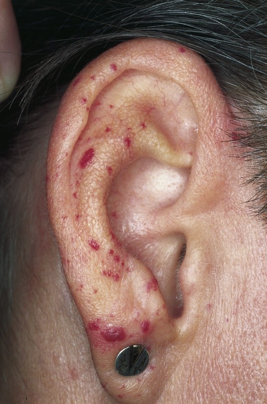 Cutaneous lesions of the external ear | Head & Face Medicine | Full Text