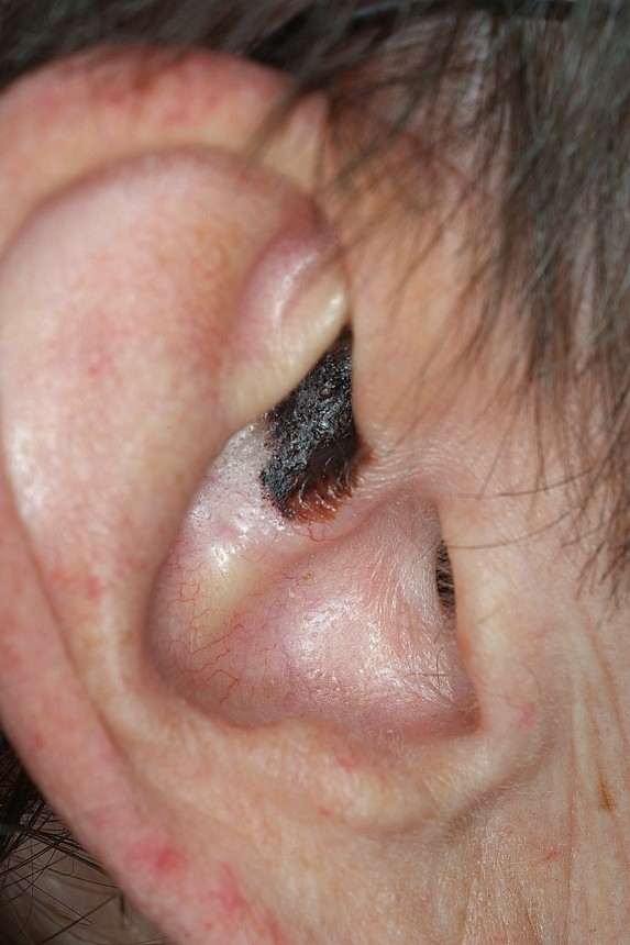 Cutaneous lesions of the external ear | Head & Face Medicine | Full Text