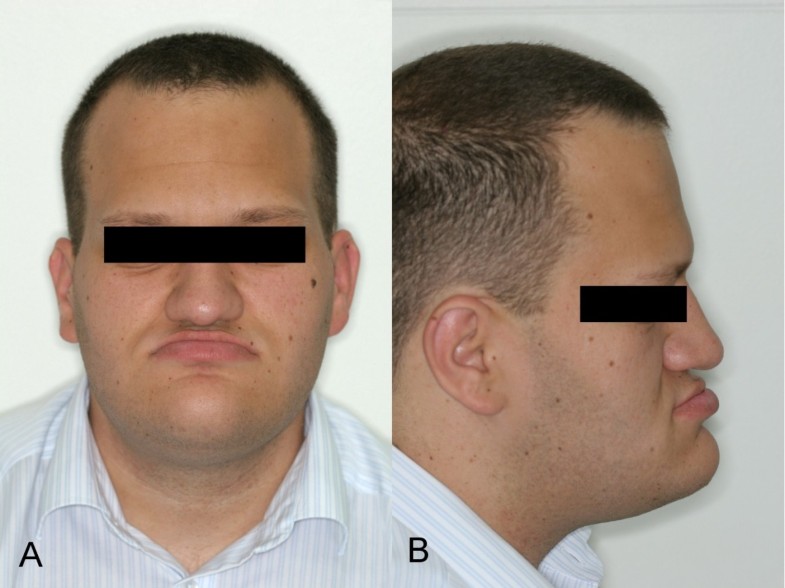 Mandibular prognathism caused by acromegaly – a surgical orthodontic ...
