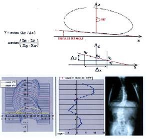 Developing a tool to measure objectively the rib hump from an ...