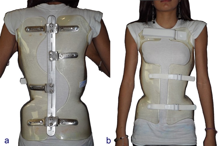 Prospective study and new concepts based on scoliosis detorsion of the ...