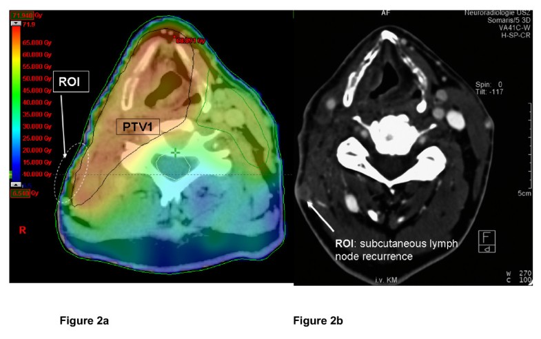Postoperative IMRT in head and neck cancer | Radiation Oncology | Full Text