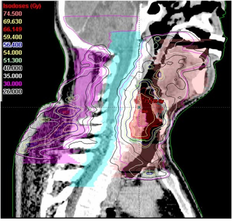 IMRT using simultaneously integrated boost (SIB) in head and neck ...
